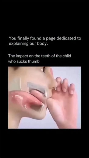 Explaining Our Body on Instagram: "Thumb-sucking might look innocent, but the long-term impact on a child’s teeth and jaw development is more serious than most parents realize. When a child repeatedly sucks their thumb, the constant pressure pushes the upper front teeth forward, misaligns the bite, and can even reshape the roof of the mouth. Over time, this can lead to overbites, open bites, speech issues, and costly orthodontic treatment. This is exactly what happens inside the mouth during pro