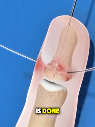 Understanding Finger Fracture Surgery with 3D Animation