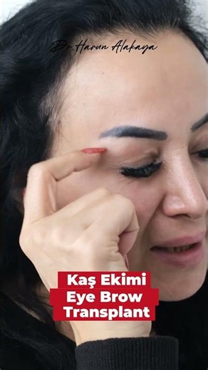 FUE Longbrow Technique for Eyebrow Transplantation