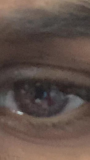 Cornea Transplant: A Look into My Eyes