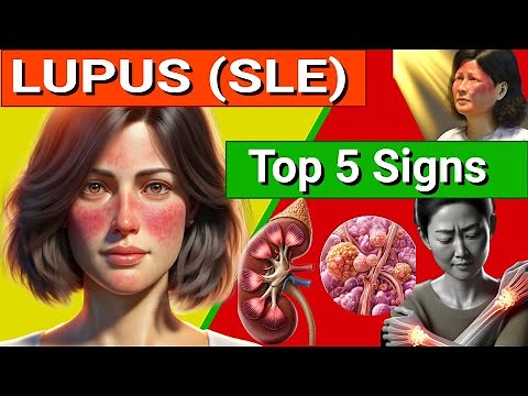 Systemic Lupus Erythematosus - Signs, symptoms, causes and Treatment