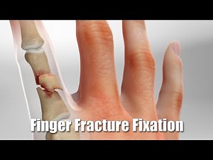 Finger Fracture Fixation (3D Animation)