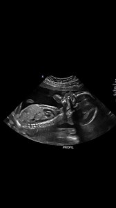 Arlo is living proof that movements matter. | Count the Kicks