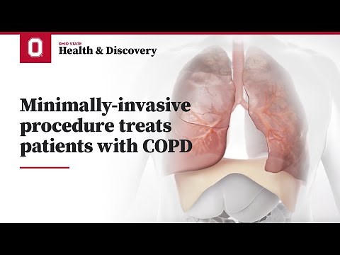 Minimally-invasive procedure treats patients with COPD | Ohio State Medical Center
