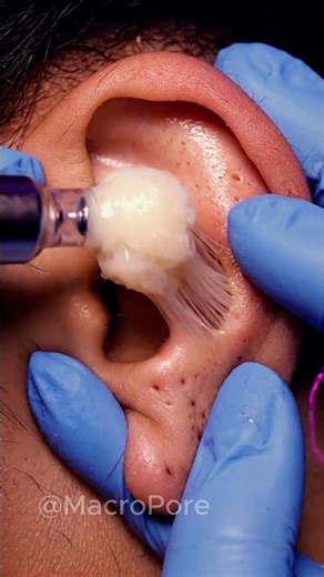Ear Vacuum Sebum Extraction | Extreme Macro 4K #macroasmr #4kmacro #satisfying