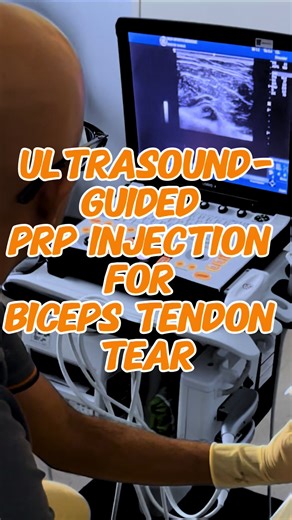 Ultrasound-Guided PRP Injection for Biceps Tendon Tear
