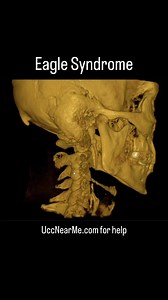 Eagle Syndrome can leave people with lightheadedness, Dizziness, Vertigo, Migraines, and a whooshing sound around the ear. Upper cervical care is excellent at helping resolve these issues! Comment help for a doctor near you! #vertigo #dizziness | Upper Cervical Chiropractor Near Me