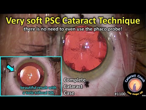CataractCoach 1100: technique for very soft PSC cataract surgery