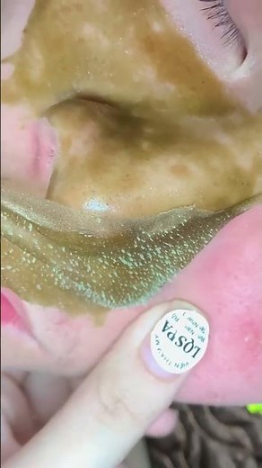 “Blackhead Removal Treatment 😍 | Whiteheads Clean | Satisfying Facial”