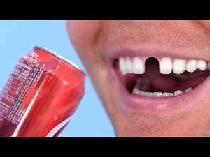 Coca Cola Knocks Tooth out!