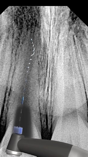 Dr. Najeeb Hmedosh | Endodontist on Instagram: "Tooth #8 •Diagnosis: 9 years kid, avulsed tooth Patient came for RCT after placing the retainer. • Instrumentation: Xp- end shaper - finisher. • Apical plug: - collagen sponge was placed. - MTA plug using map system. • Obturation: Bio Ceramic Sealer with warm backfilled technique. At: @harmonymcad #endo #dentist #explore"