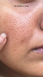 6.4K views · 9.3K reactions | ✨ Say goodbye to visible pores and...