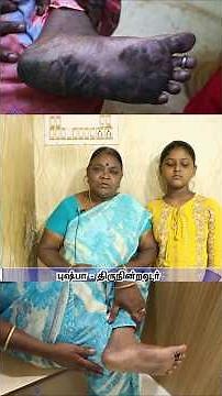 Psoriasis on feet and palms 😳 See how it has changed to this 😲 | Psoriasis