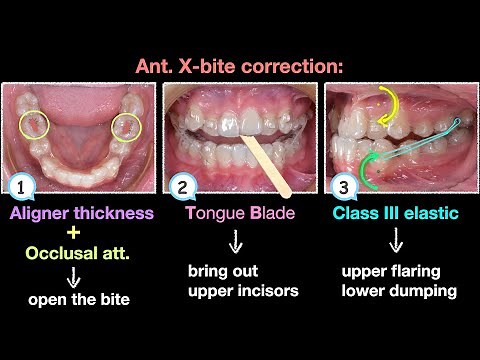 Anterior crossbite clinical tip (aligner)｜【Chris Chang Ortho】CC753