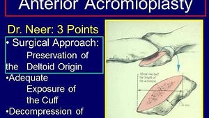 Dr. Neer’s Contribution to the Diagnosis and Treatment of Impingement Syndrome and Rotator Cuff Tears