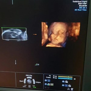 ايكو رباعي الابعاد 4D echo جنين بعمر 16 اسبوع. الدكتور سيداحمد أسيساح اخصائي امراض النساء والتوليد والعقم Clinique kawthar مصحة الكوثر للطب و الجراحة 43010683-20356409 العنوان على الخريطة https://maps.app.goo.gl/3Zq2W9gJwDYxriFFA | الدكتور سيداحمد أسيساح اخصائي امراض النساء والتوليد والعقم