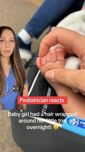 Hair tourniquet syndrome is a condition where a hair or thread becomes so tightly wrapped around a body part, most commonly a finger, toe, or genitalia, that it constricts blood flow, causing pain and swelling. If not treated promptly, it can lead to permanent damage to the appendage. Treatment involves surgically removing the hair/thread, or in some cases, using a depilatory cream for a pain-free removal. Causes * A caretaker’s hair or loose clothing threads can wrap around an appendage, and th