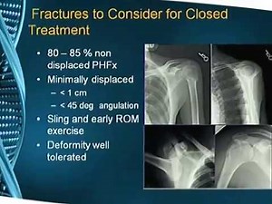 Proximal Humerus fractures