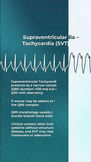 Ventricular vs Supraventricular Tachycardia on an EKG