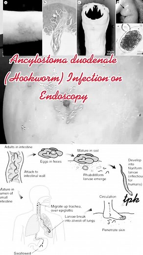 Hookworms are parasites that live in the intestines of infected people. Hookworm eggs (larvae) spread in the feces (poop) of people with hookworm disease. Many people have no symptoms, but signs of a hookworm infection include skin rash, fever, stomach pain and diarrhea