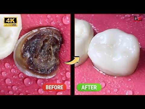 AMAZING restoration of tooth with extensive cavity: RCT in 4K