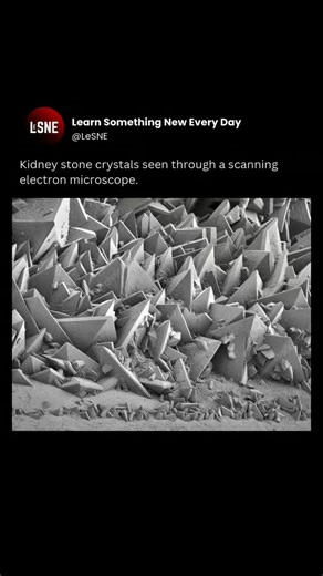 @LeSNE | @LeSNE(2414)... The stones primarily composed of calcium oxalate crystals, can manifest as sharp, pointed, or tabular shapes depending on... | Instagram