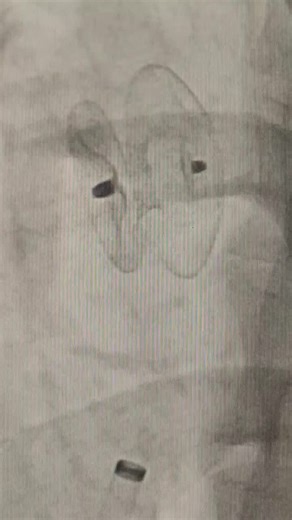 ASD DEVICE CLOSURE A 29-year-old male , recently diagnosed with CAD- NSTEMI, ACHD - Ostium Secundum ASD with Left to rightshunt. He underwent CAG on 10.11.2025, which revealed SVD with mild ISR in… | Anandhu GT