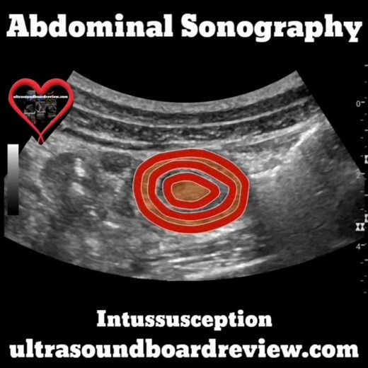 Intussusception Ultrasound