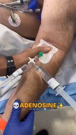 Pure medicine on Instagram: "In the world of emergency medicine, a few seconds can change everything — and Adenosine is the perfect example of that. ⚡ This life-saving drug works like a magic reset button for the heart, used in cases of Paroxysmal Supraventricular Tachycardia (PSVT) — when the heart suddenly starts racing way too fast. 💔 Adenosine acts on the A1 receptors in the AV node, temporarily blocking conduction through it. This brief pause allows the heart’s natural pacemaker — the SA n