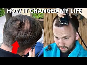 I Shaved Off My Combover *Transformation*