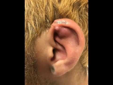 Left Ear Helix Abscess: Chondritis or Not?