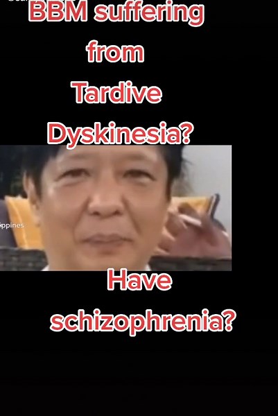 Understanding Tardive Dyskinesia: Symptoms and Causes Explained