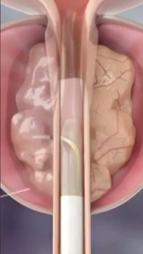 Rezum water vapour Therapy procedure by Surgeon #ajaydader