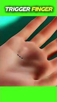 How Do Doctors Fix Trigger Finger?