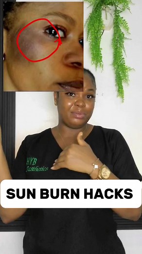 Understanding the Difference Between Exogenous Ochronosis and Sunburn