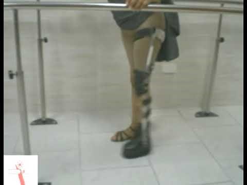 Polio woman with a legbrace and built-up shoe in rehab.