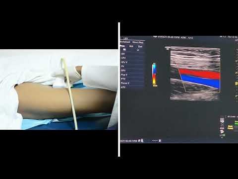 Lower Extremity DVT Ultrasound Protocols