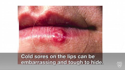 30K views · 219 reactions | Cold sores on the lips can be...