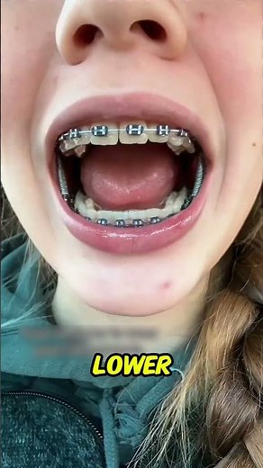 How This Tiny Device Fixes an Overbite 🦷