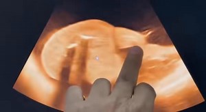 Twin Reversed Arterial Perfusion (TRAP sequence) គឺជាជម្ងឺកម្រមួយកើតនៅក្នុង ទារកភ្លោះ (ជាទូទៅគេឃើញនៅក្នុង ភ្លោះដើមគ្រួស - monozygotic, monochorionic twins)។ ក្នុងស្ថានភាពនេះ មានទារកមួយ ខូចខាតយ៉ាងខ្លាំង ហើយទទួលឈាមពីភ្លោះម្ដងទៀតតាមទិសបញ្ច្រាស — ដោយមិនមានបេះដូងផ្ទាល់ខ្លួនសម្រាប់បូមឈាមទេ។ 👶 តើទារកបែបនេះមានលក្ខណៈដូចម្តេច? TRAP Sequence បង្កើតទារកមួយ (ហៅថា acardiac twin) មានលក្ខណៈខុសប្រក្រតីយ៉ាងខ្លាំង៖ 1. /មិនមានបេះដូង (acardiac)→ មិនអាចបូមឈាមឲ្យខ្លួនឯងបានទេ→ ឈាមបានមកពីភ្លោះម្ដងទៀតតាមរបៀបបញ្ច្រាស (re