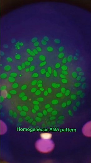 ANA patterns|| Autoimmune Diagnosis