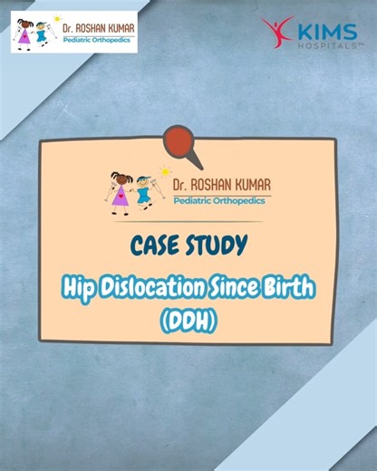 A case of congenital hip dislocation (DDH) in a female child. Surgical realignment by Dr. Roshan restored the hip to its normal level, improving posture and gait. A successful outcome and a transformed childhood ahead. 🦴✨ Consult: Dr. Roshan Kumar Jaiswal Consultant Paediatric Orthopaedic Surgeon & Complex Trauma Surgeon Specialist KIMS Hospitals, Secunderabad. To book an appointment, call 91 88973 14141 or Visit https://www.kimshospitals.com/doctor-profile/dr-roshan-kumar-jaiswal/ #DDH #Develo
