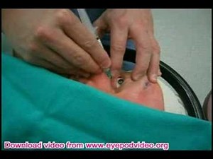 Retrobulbar injection for cataract surgery anesthesia