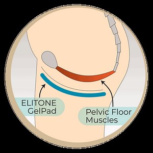Clinicians | Elitone