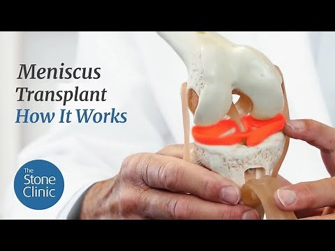 Meniscus Replacement - How it Works & What to Expect