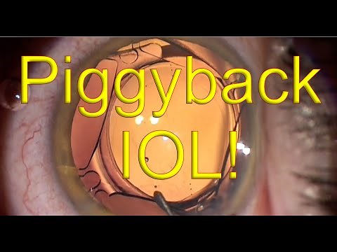 Piggyback IOL for refractive surprise after cataract surgery (1stQ AddOn lens) - Dr Simon Chen