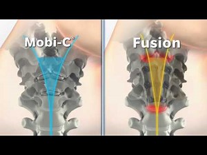 Mobi C vs. Cervical Fusion Animation