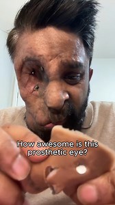20K views · 28 reactions | A man who lost his eye in an accident shows off his one of a kind prosthetic. ✅Follow @drdavidabbasi for More Daily Medical Content & Health Tips! Schedule a consultation to see Dr. Abbasi as a patient in Delray Beach! Visit www.primeorthocenter.com Vid: @amitghosenf1 | David Abbasi, MD - Sports Medicine & Orthopedic Surgery | Facebook