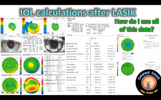 Methods for IOL calculations after prior LASIK