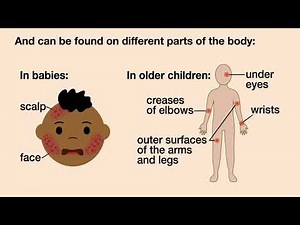 Does My Child have Eczema? | American Academy of Pediatrics (AAP)